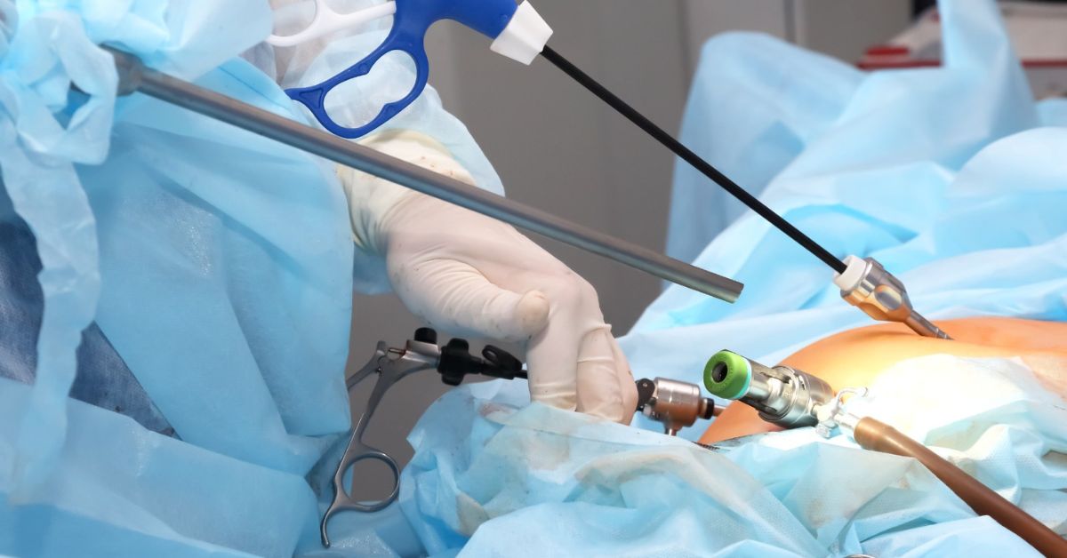 Laparoscopic Surgery vs. Open Surgery: Which Is Better?